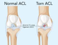 Signs and Symptoms of ACL Tears in Active Individuals | Cary Orthopaedics
